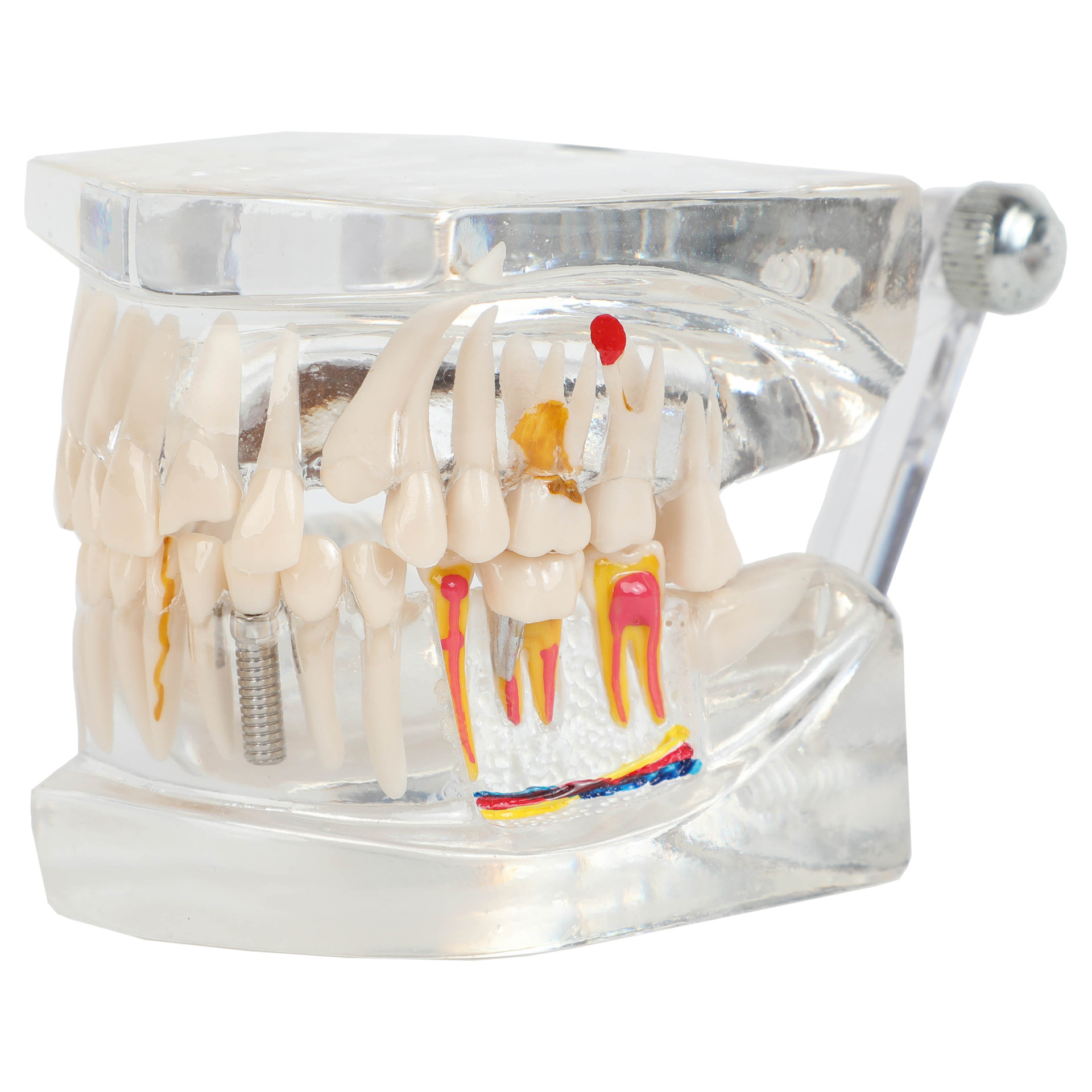 Axis Scientific Transparent Diseased Teeth Anatomy Model | Anatomy ...