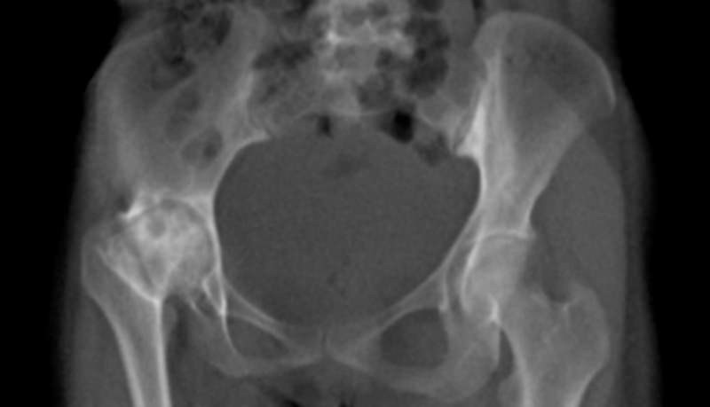 Erler-Zimmer Pelvic Phantom with Coxarthrosis for CT, X-Ray and ...