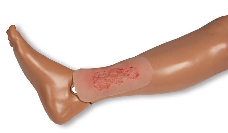 Erler-Zimmer - Wound Moulage Venous Leg Ulcer, Small, Epithelisation Phase