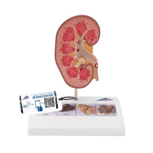 3B Scientific - Kidney Stone Anatomy Model