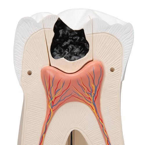 3B Scientific - Giant Molar Anatomy Model With Dental Caries