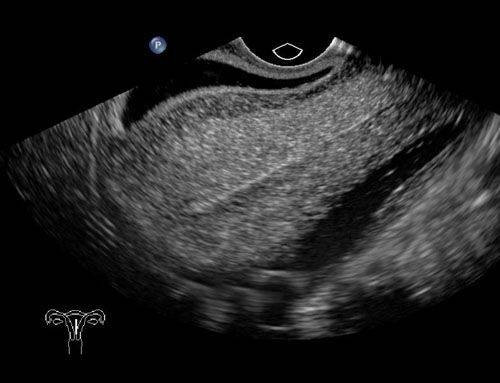 Transvaginal SonoHysterography and Sonosalpingography Ultrasound ...