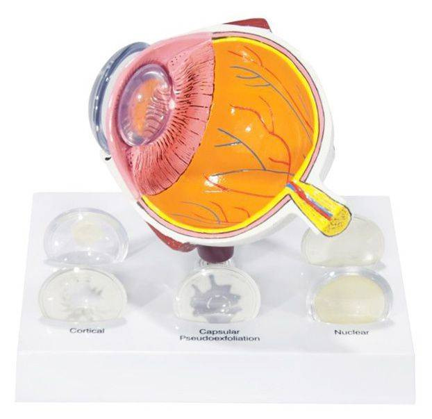GPI Anatomicals Cataract Eye Anatomy Model | Anatomy Warehouse
