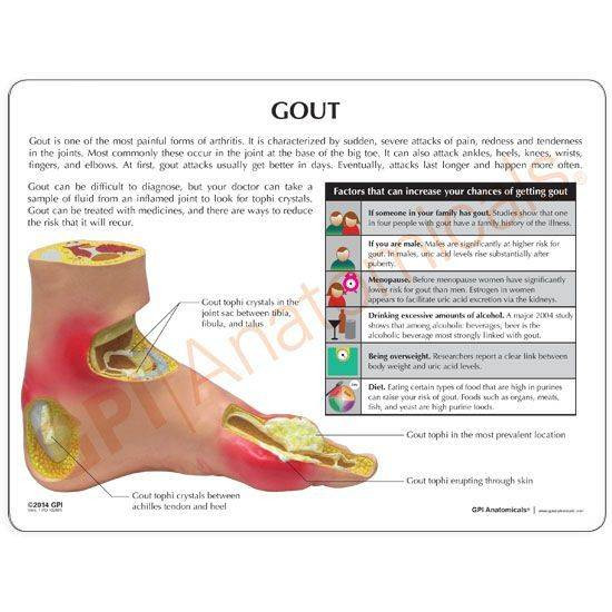 GPI Anatomicals Foot with Gout Anatomy Model | Anatomy Warehouse