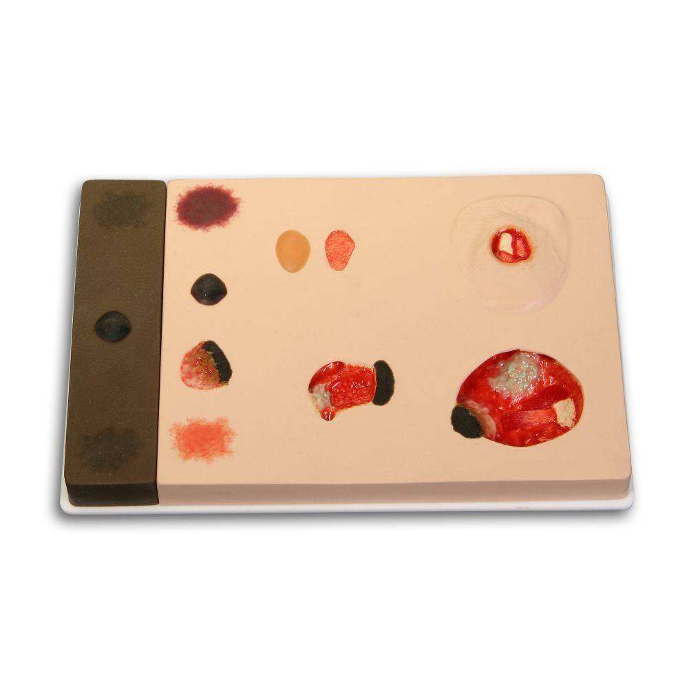 Pressure Ulcers, Stages 1-4, Set of 4