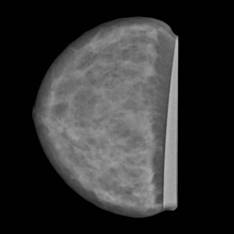 Erler-Zimmer Breast Phantom for Mammography and Breast Tomosynthesis ...