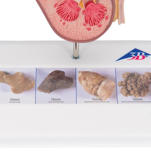 3B Scientific - Kidney Stone Anatomy Model