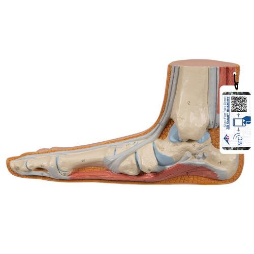 3B Scientific - Hollow Foot (Pes Cavus) Anatomy Model