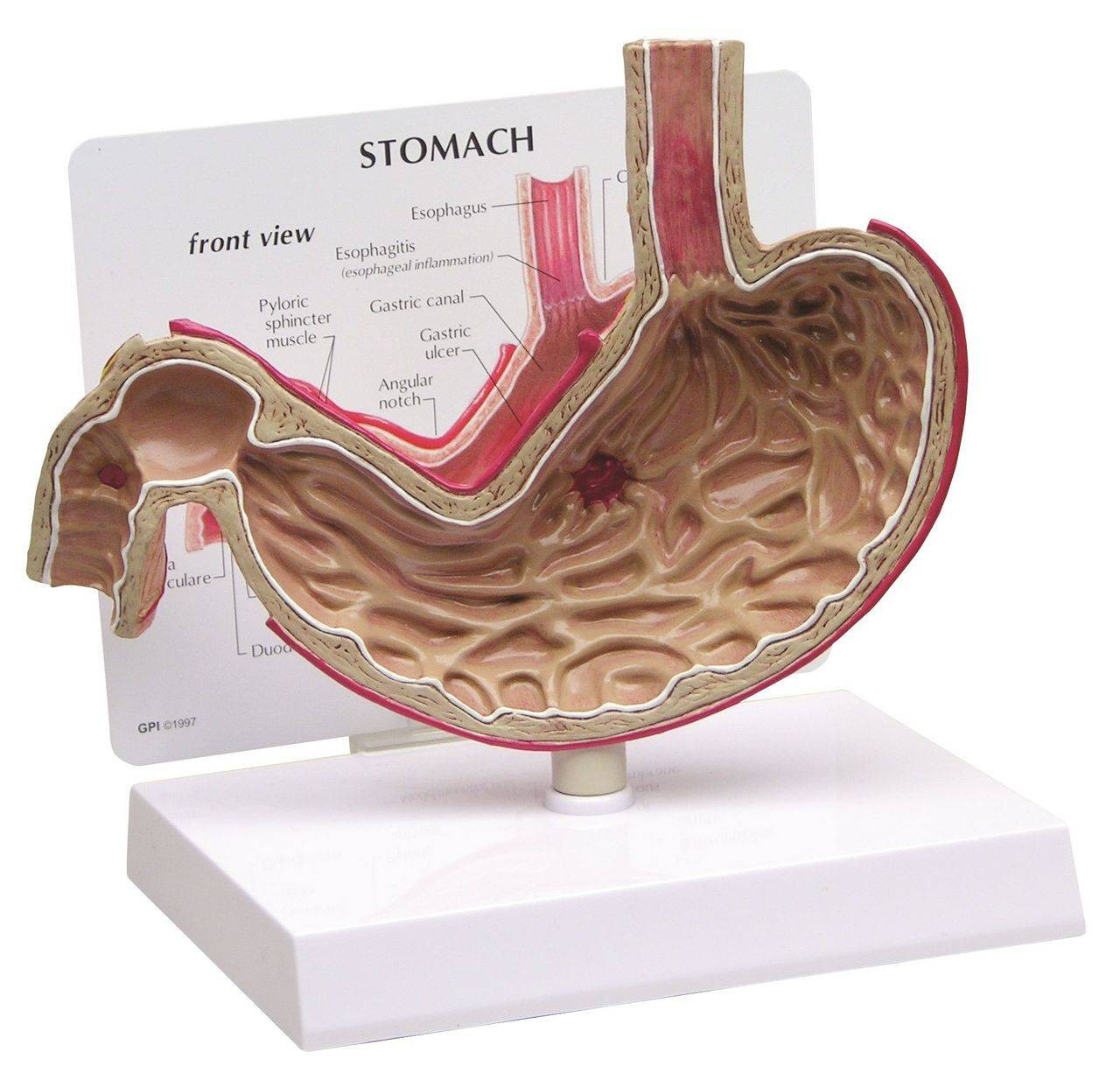 Anatomy Model Diseased Teeth and Gums