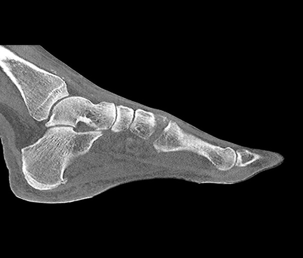 Foot Phantom for CT, X-Ray and Radiation Therapy