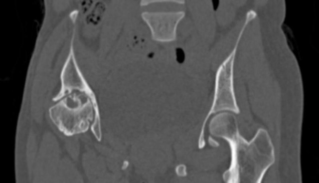 Erler-Zimmer Pelvic Phantom with Coxarthrosis for CT, X-Ray and ...