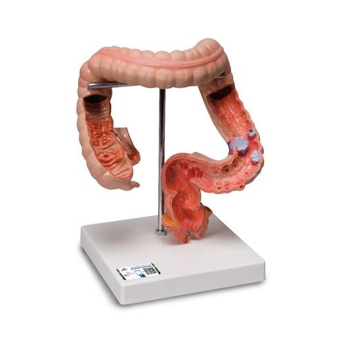 Anatomy Model Rectum with Pathologies