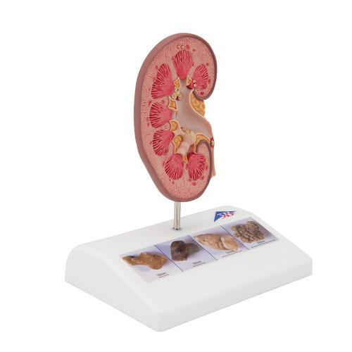 3B Scientific - Kidney Stone Anatomy Model