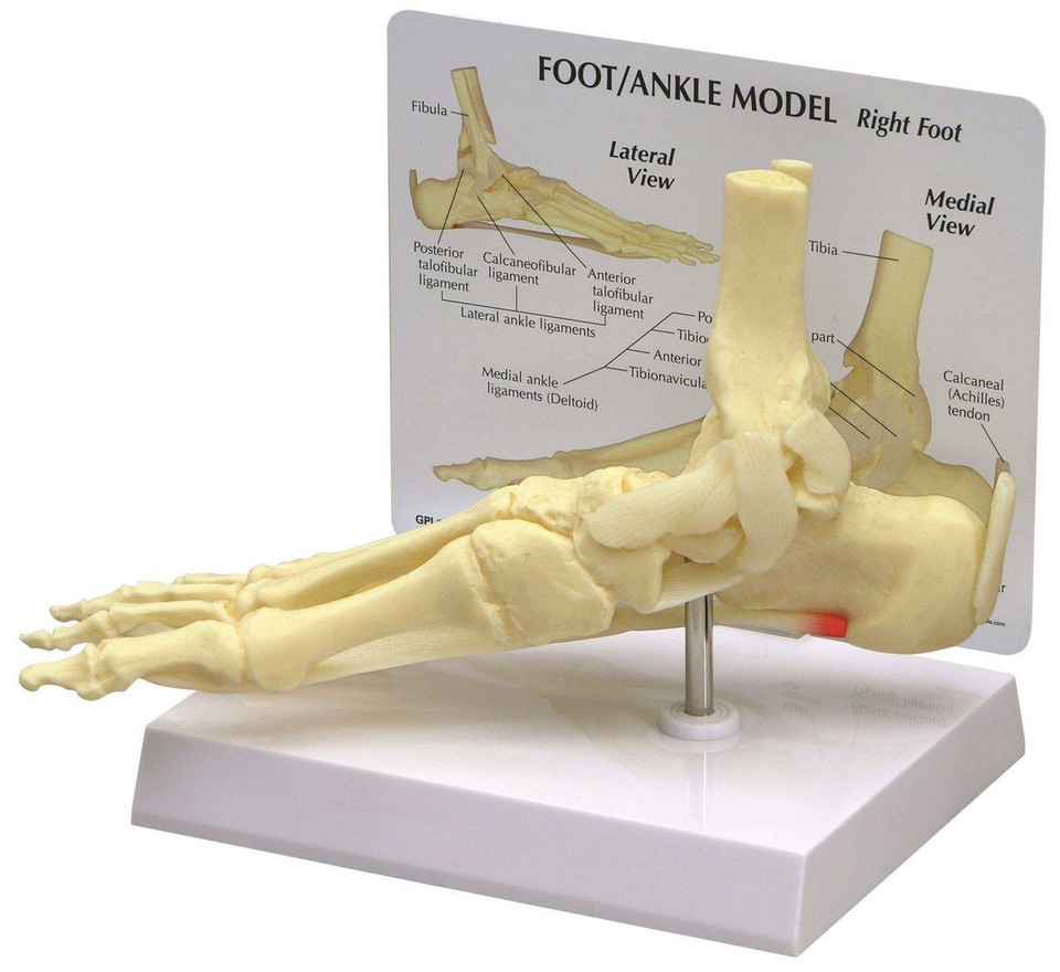 3B Scientific - Hollow Foot (Pes Cavus) Anatomy Model