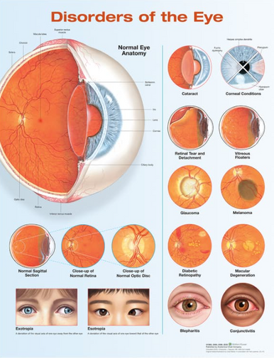 Anatomical Chart Company Disorders Of The Eye Laminated Anatomical ...