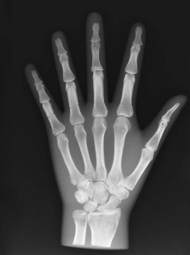 Erler-Zimmer X-Ray Phantom Hand, Opaque | Anatomy Warehouse
