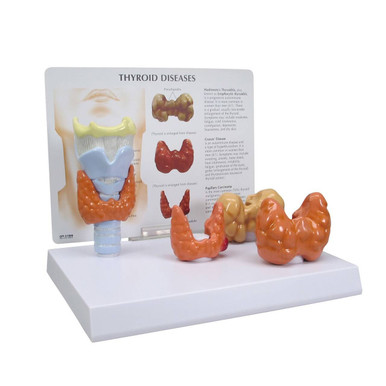 GPI Anatomicals Thyroid Disease Anatomy Model | Anatomy Warehouse