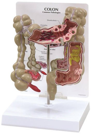 GPI Anatomicals Colon Anatomy Model With Pathologies | Anatomy Warehouse