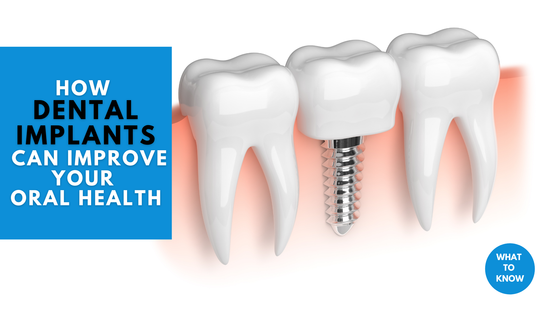How Dental Implants Can Improve Your Oral Health - What to Know ...