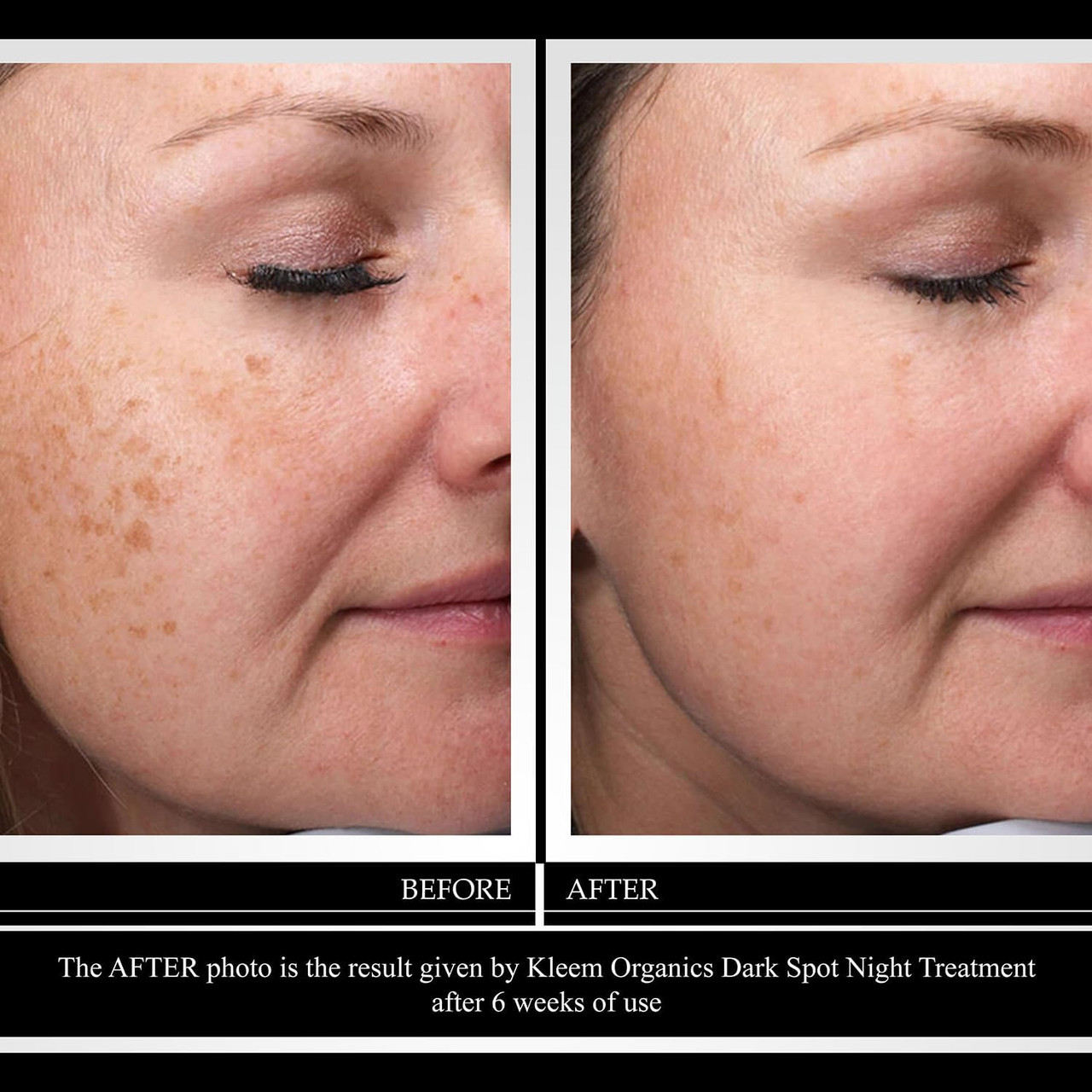 Kleem Organics - Anti-Aging Dark Spot Corrector Serum for Face, Hands ...