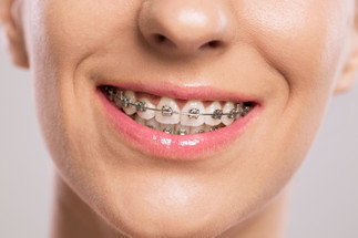 Fitting Your SOVA Night Guard With Braces SOVA Night Guard