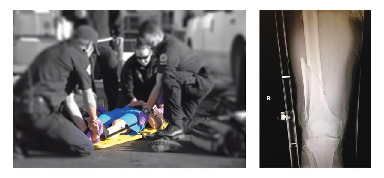 Traction Splint Comparison | Types and Uses in Femoral Traction ...