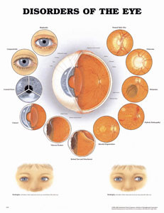 Disorders of Eye Anatomical Chart - Medex Supply