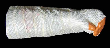 Elsa - Arm Cast - Toy Anxiety