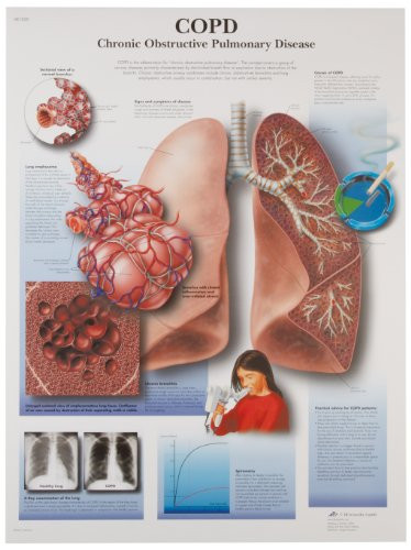 3B Scientific VR1329UU Glossy Paper Copd Chronic Obstructive Pulmonary ...