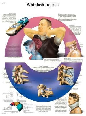 VR1761UU - Whiplash Chart - 3B Scientific Whiplash Chart - Each ...