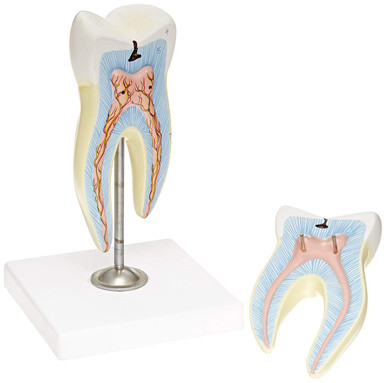EISCO Upper Triple Root Molar with Caries Model, Enlarged 15 Times, 2 ...