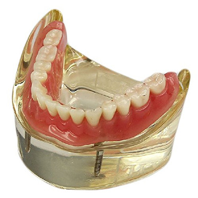 SOARDAY Dental Mandibular Removable Overdenture Model with 2 implants ...