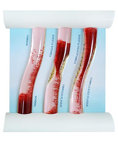Low Density Lipoprotein LDL Blood Vessel Model for Medical Patient ...