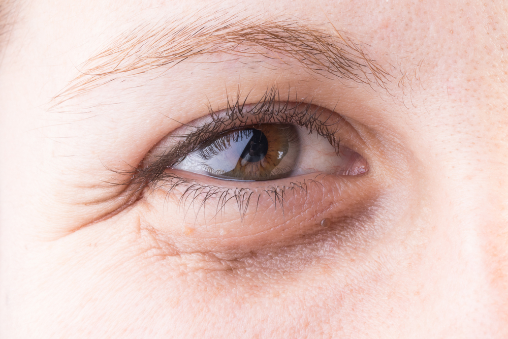 9 Causes Of Dark Eye Circles Take Action To Reduce Dark Circles Under 