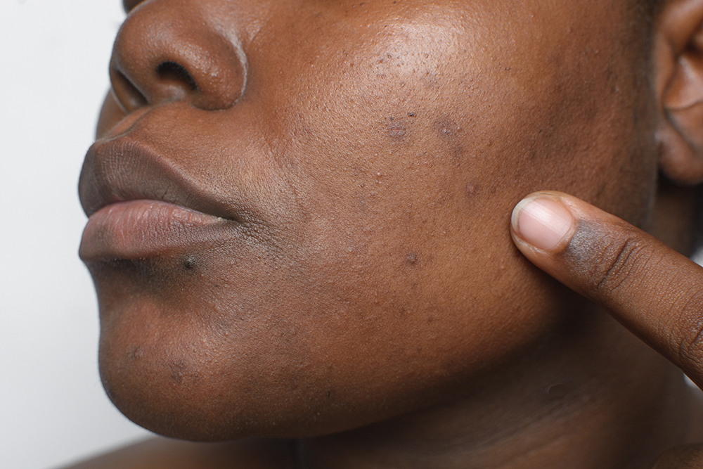 Why do I have hyperpigmentation? 9 reasons dark spots show up on skin ...