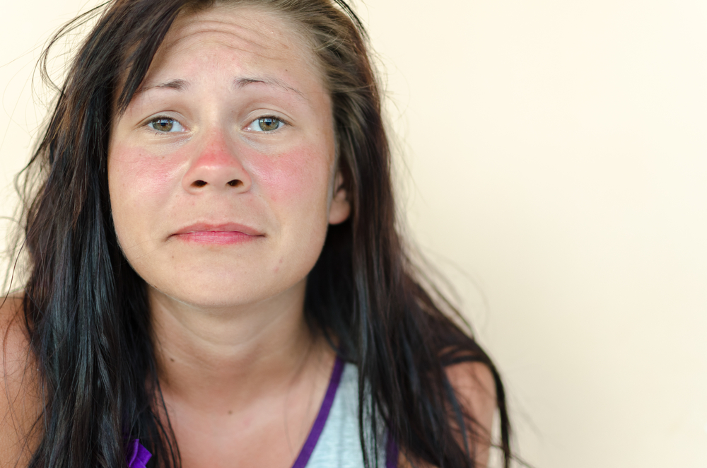 Do I Have Rosacea? Your Microbiome May Be Partly To Blame For Red ...