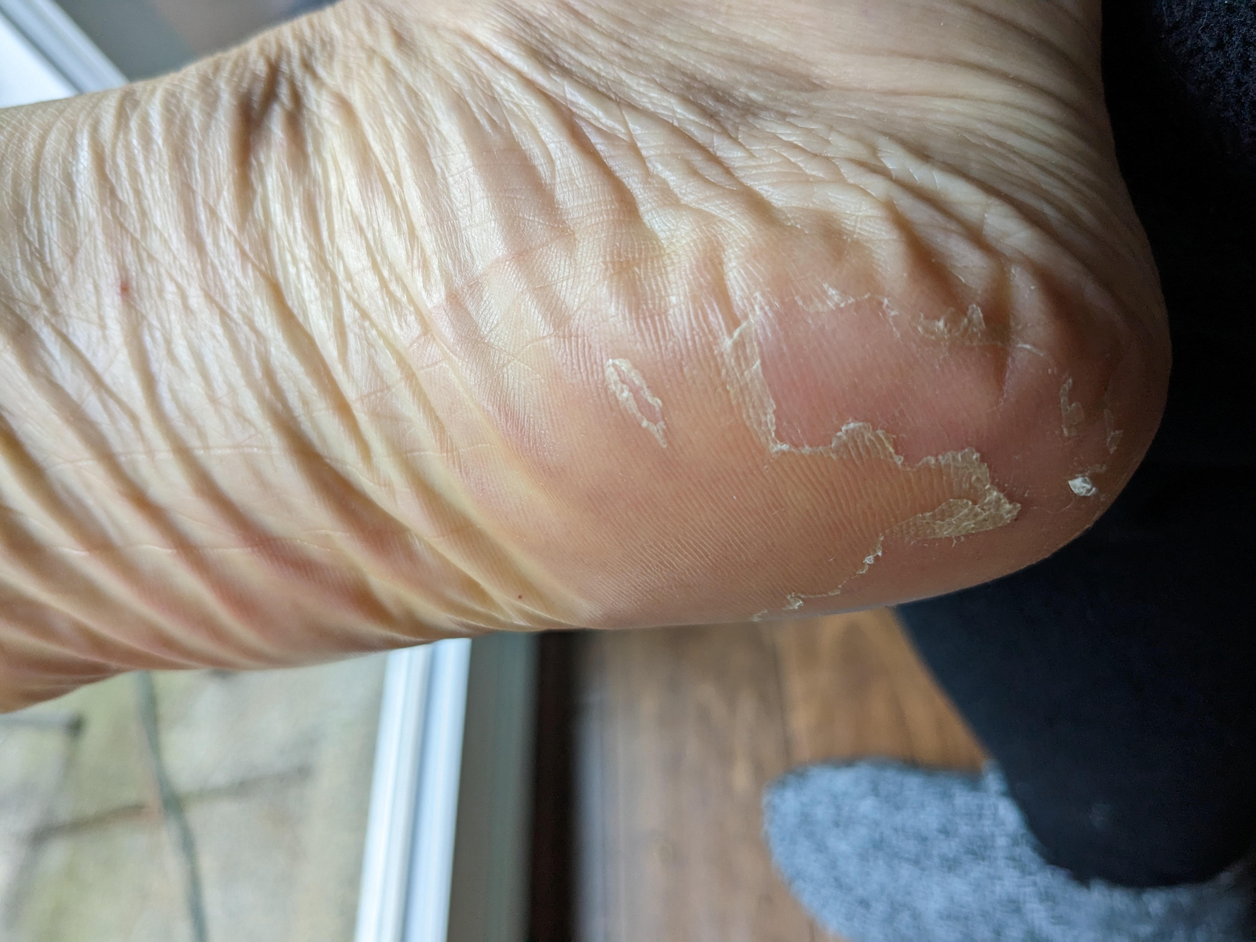 How to Soothe Dry, Red Cracked Hands and Feet from Chemotherapy ...