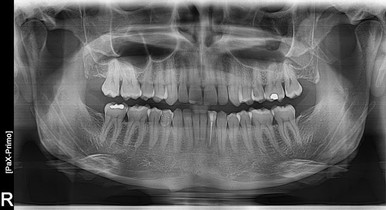 Air Techiques Scanx Dental Cr Radiology 15X30 Cm Two Plates ...