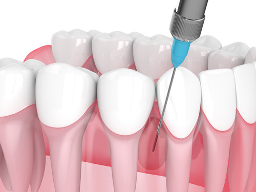 Septocaine (Articaine) local anesthetic in dentistry
