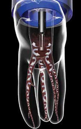 GentleWave Enhanced Endodontic Irrigation