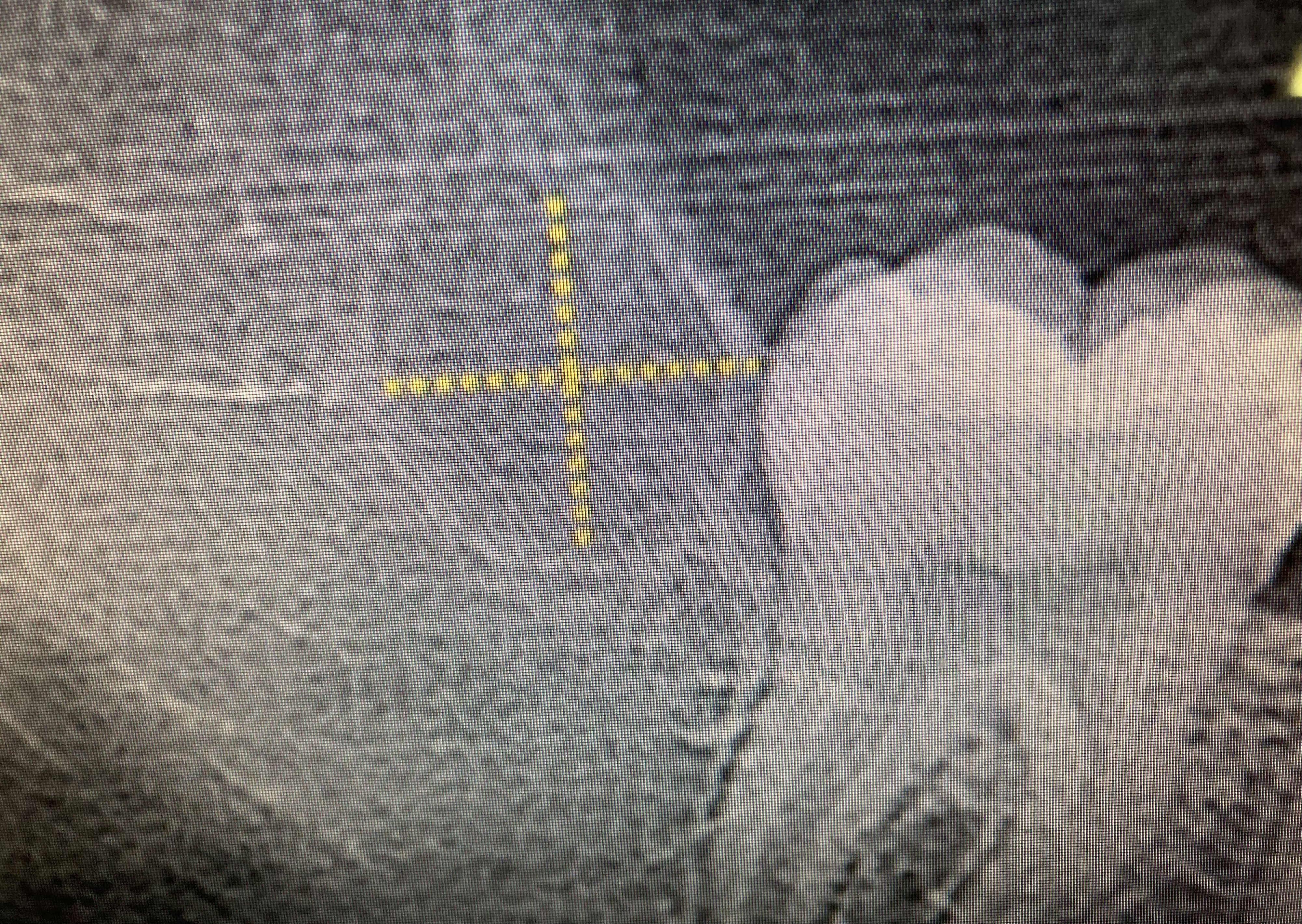 Zero3 TBA Third Molar (Wisdom Teeth) Management: early ablation versus ...