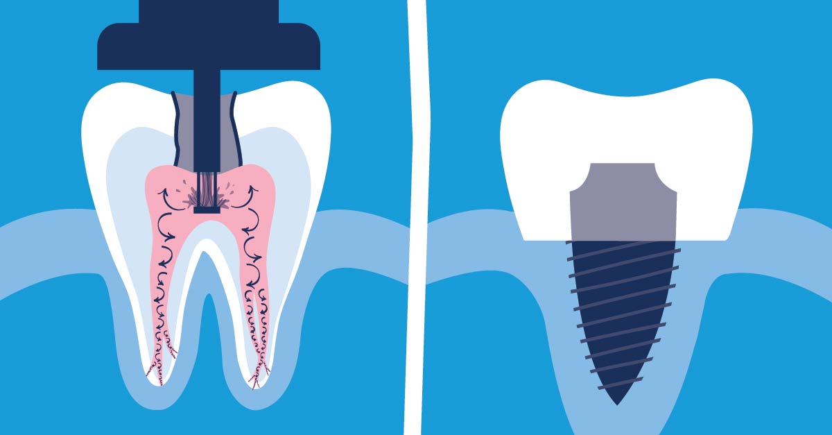 Deciding Between Root Canal And Implant Dental Didactics Ce