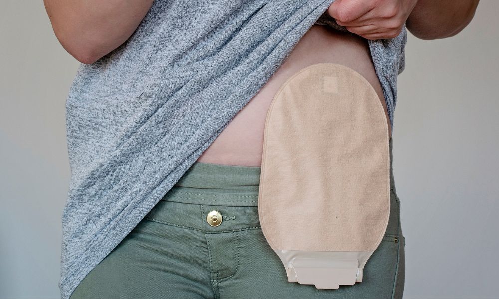 Best Practices For Living With An Ostomy Bag My Care Supplies
