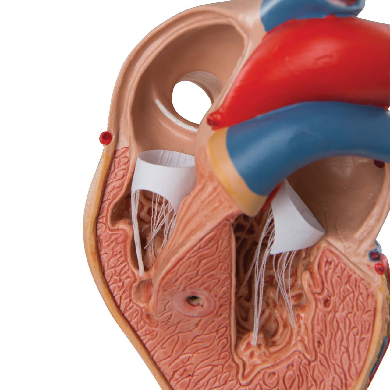 Classic Heart with Left Ventricular Hypertrophy (LVH), 2 part ...
