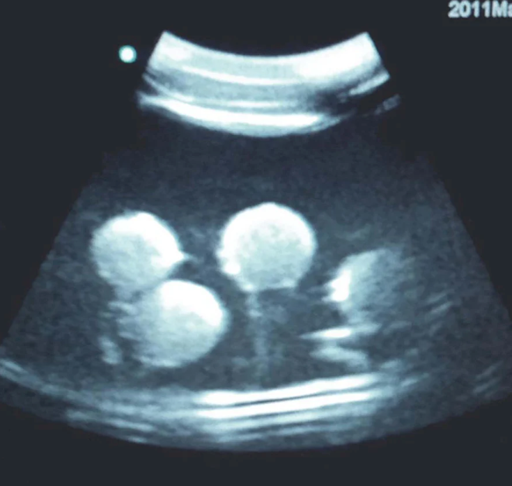 Ultrasound Paracentesis Trainer