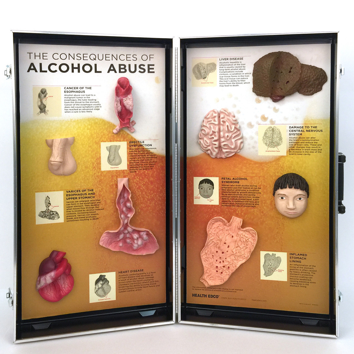 The Consequences of Alcohol Abuse 3D Display - Southern Biological