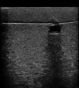 Ultrasound Guided IV Access Arm System