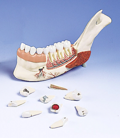 3B Scientific Half Lower Jaw 8 Diseased Teeth Mode VE290