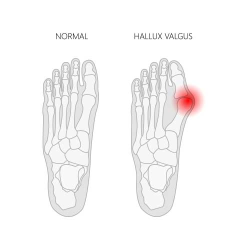 BUNION CAUSES, SYMPTOMS, AND TREATMENT - BioSkin LLC