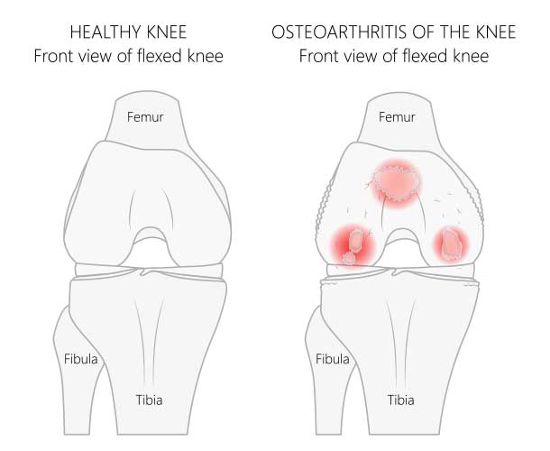 Knee Osteoarthritis: Causes, Symptoms, and Treatment